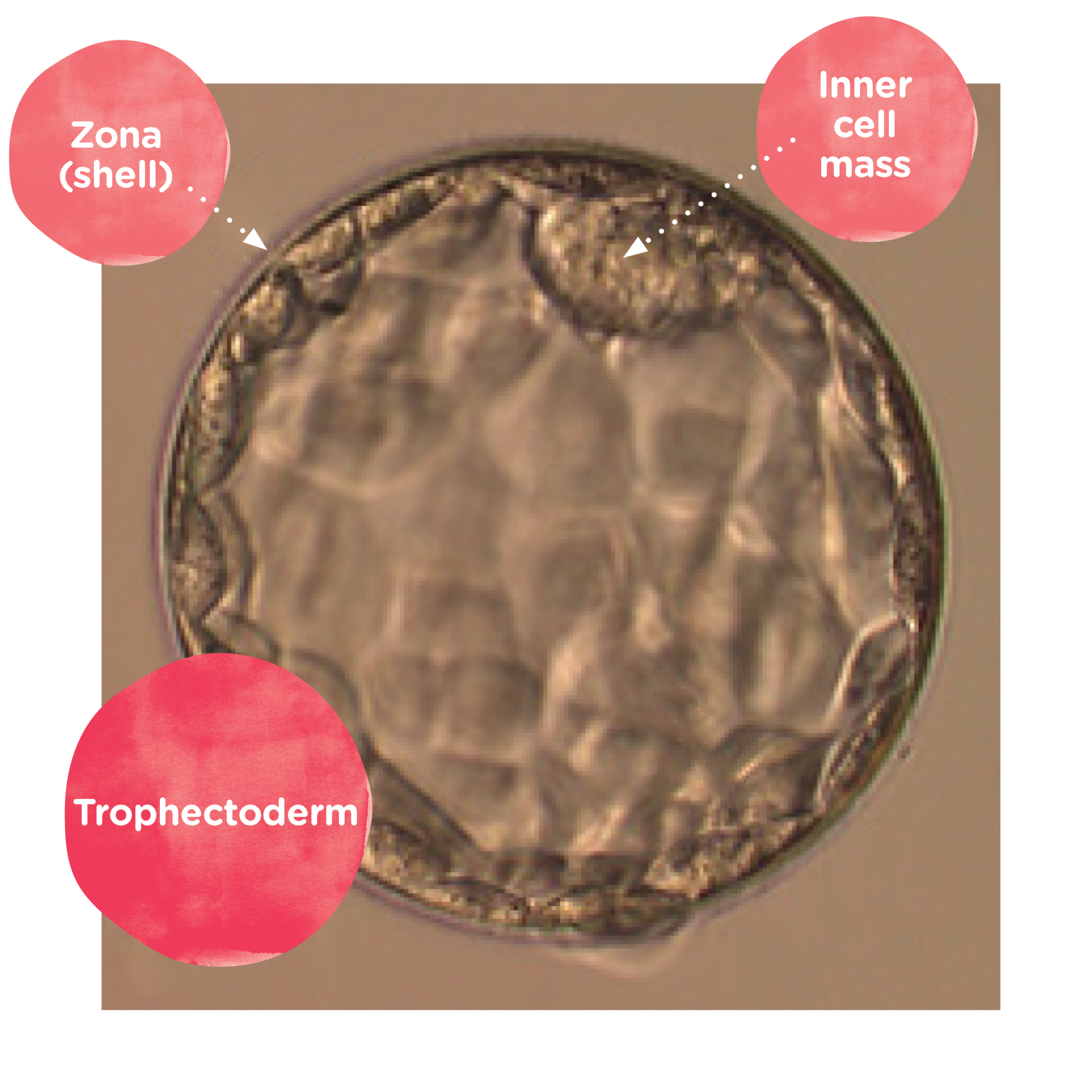 IVF New Zealand | In Vitro Fertilisation treatment options | Repromed